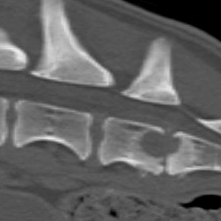 Discospondylitis - Movement Referrals