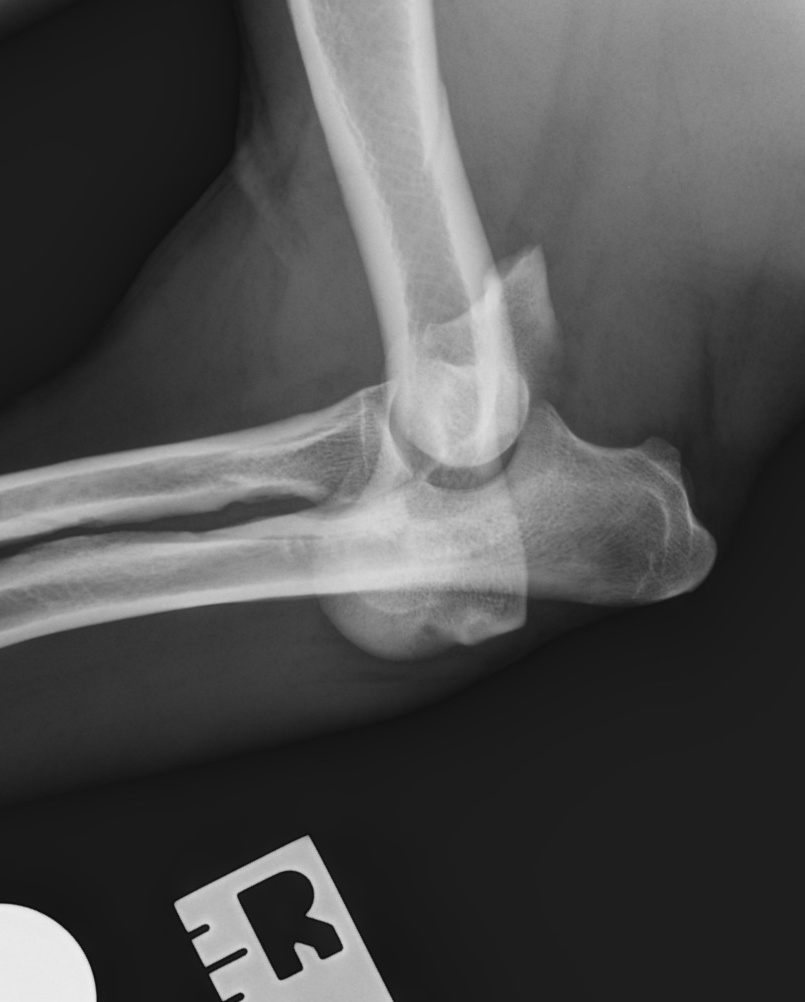 Humeral fractures - Movement Referrals