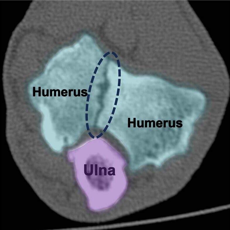 Humeral intracondylar fissure (HIF)(IOHC) - Movement Referrals