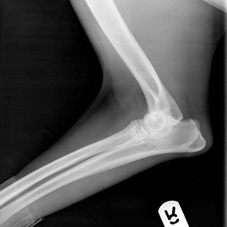 Elbow - Movement Referrals