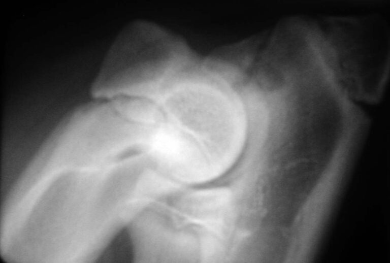 Elbow - Movement Referrals