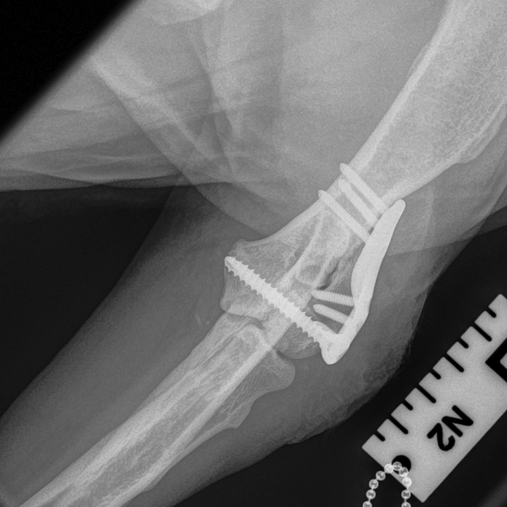 Fractures - Movement Referrals