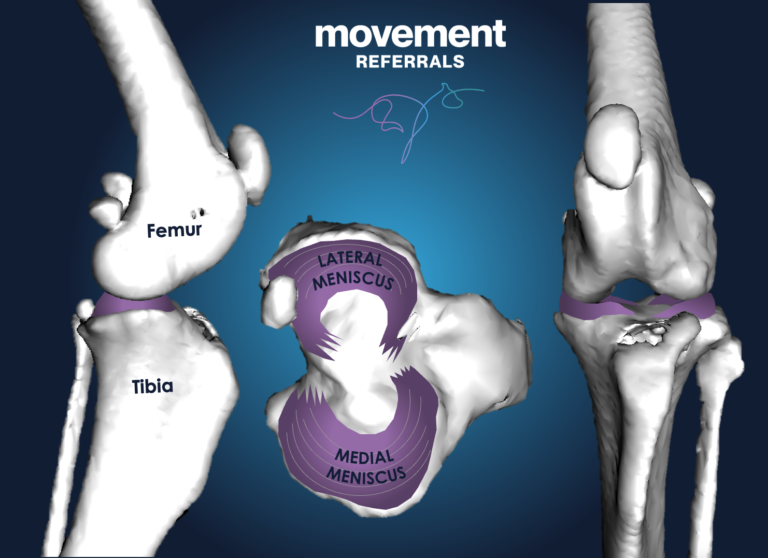 Meniscal injuries - Movement Referrals