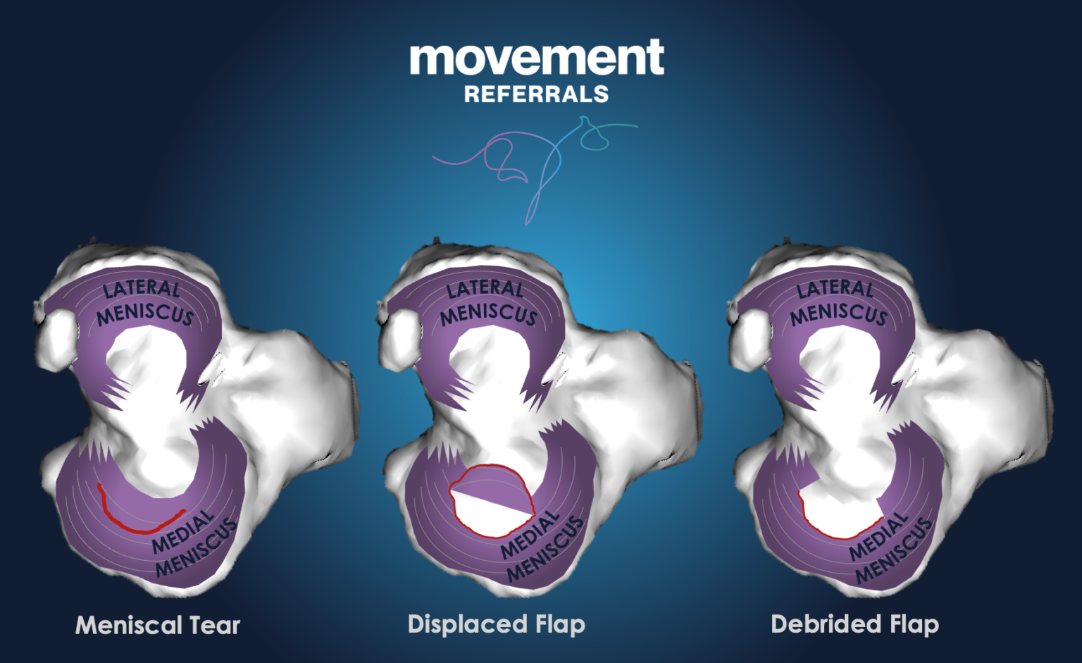 Meniscal injuries - Movement Referrals